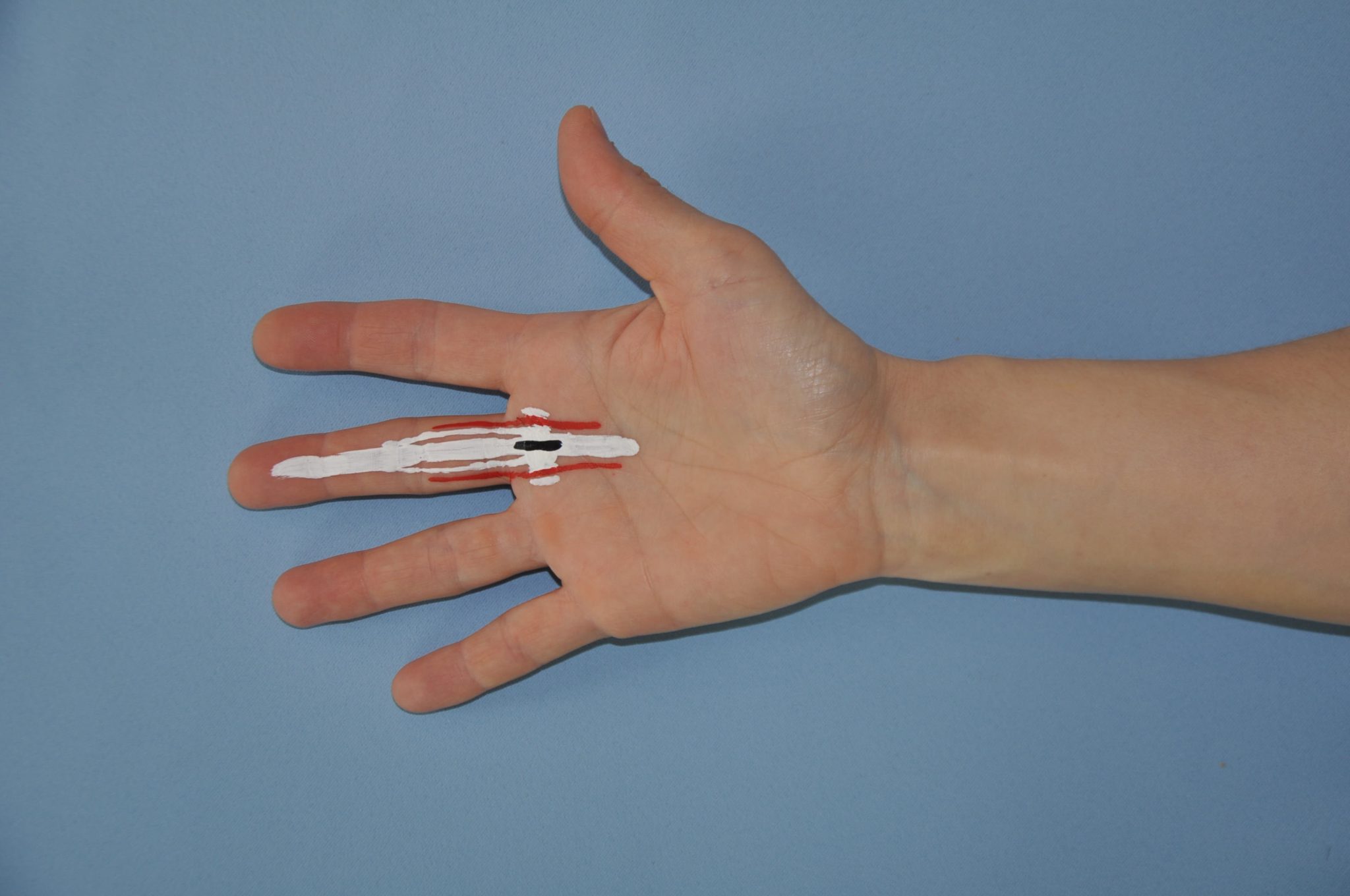 Tendovaginitis stenosans (Springfinger) – Chirurgische Praxisklinik im ...